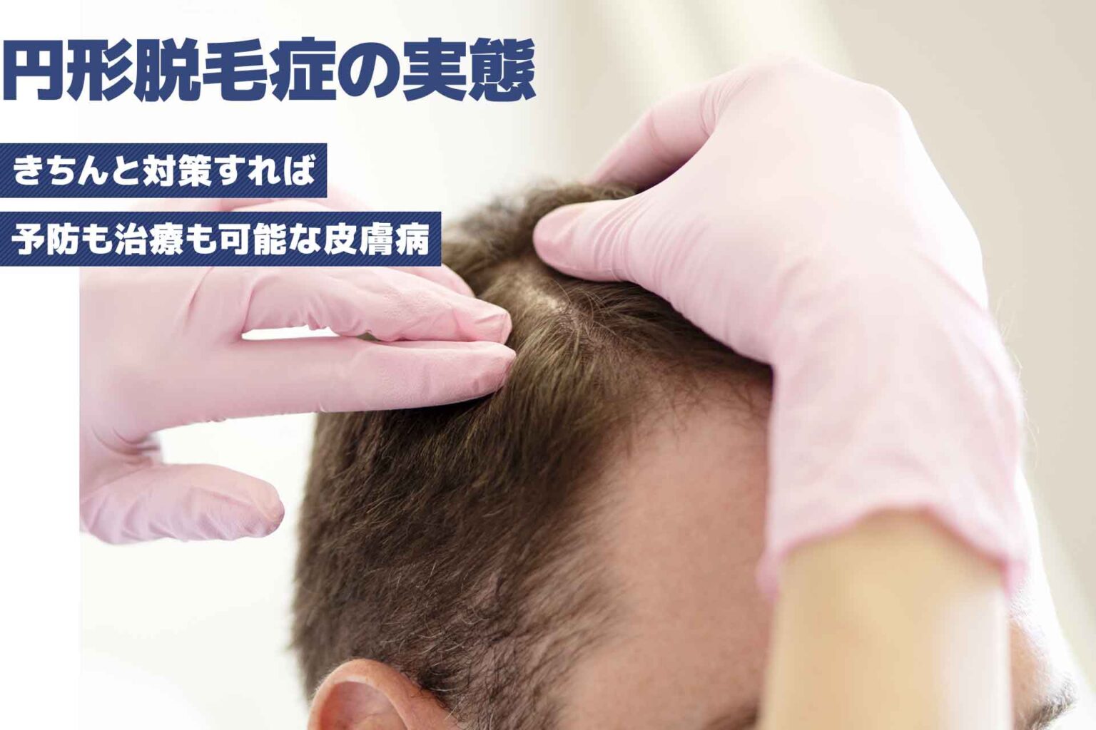【医師監修】円形脱毛症になったら病院に行くべき？原因と改善方法を解説 | Midashinami for AGA
